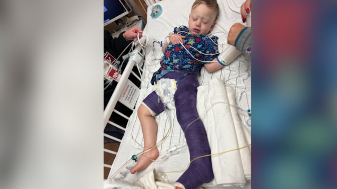 Toddler's limp was a sign of hip dysplasia,… | Riley Children's Health