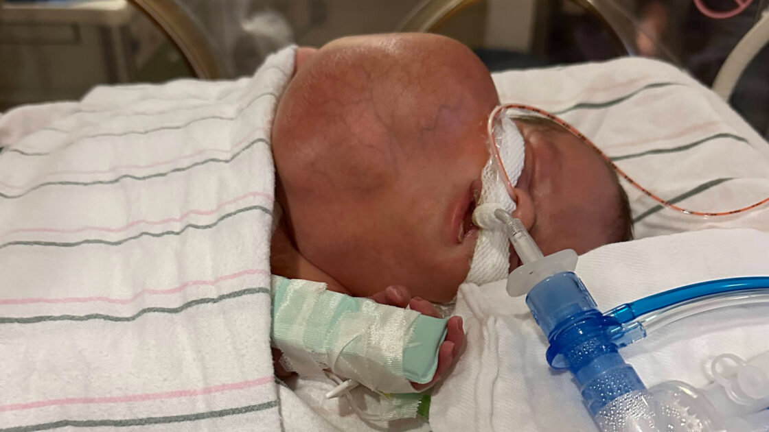 Riley team saves baby born with neck tumor… | Riley Children's Health