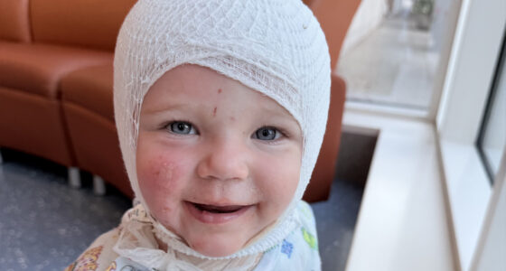 Burn Program | Riley Children's Health