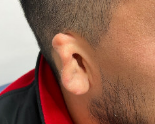 Congenital Ear Anomalies | Riley Children's Health