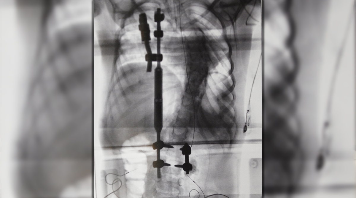 “Growing rods” can help straighten tiny… | Riley Children's Health